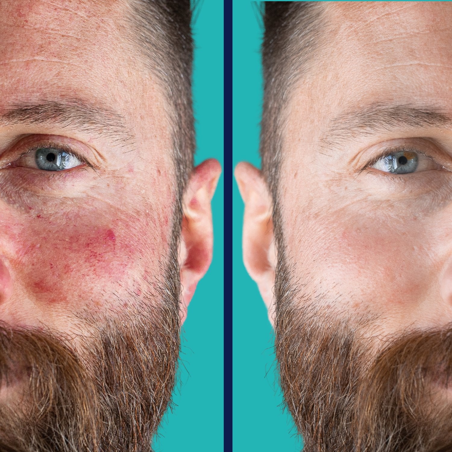 Anti Redness Skincare Products For Men | The Aussie Man